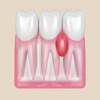 ציסטות בפה טיפול - מרכז כירורגי שוורץ-ארד